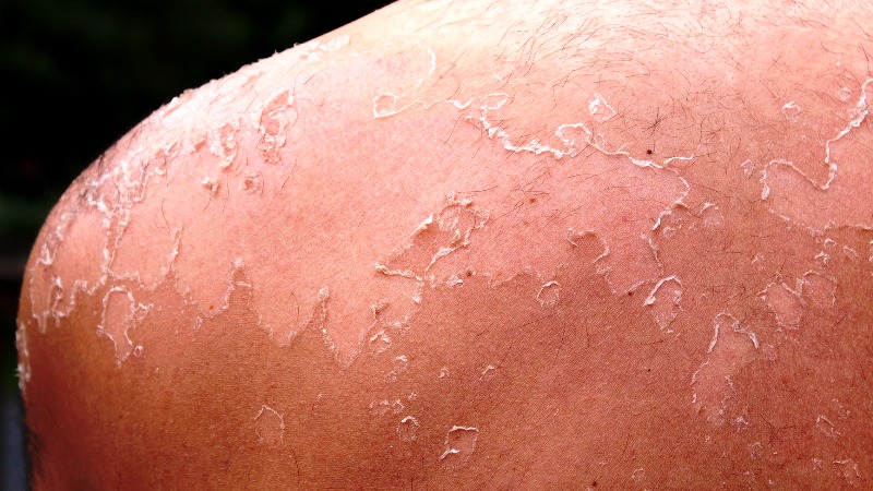 Protege tu piel de la exposicion al sol – Noticias | Actualidad ...